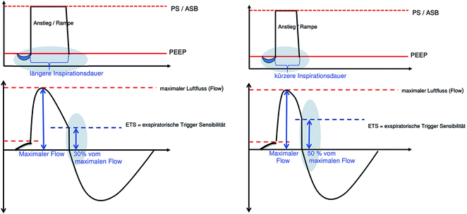 Druckunterstützende Beatmung (PSV) | SpringerLink
