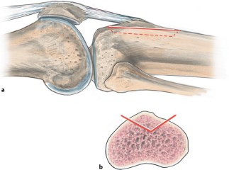 Patella | SpringerLink