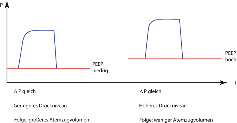 Druckkontrollierte Beatmung | SpringerLink