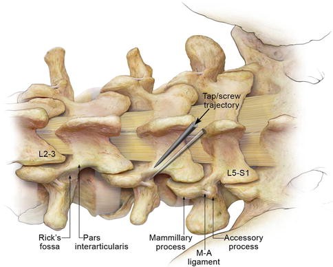Minimally Invasive Wiltse Approaches for Posterolateral Fusion ...