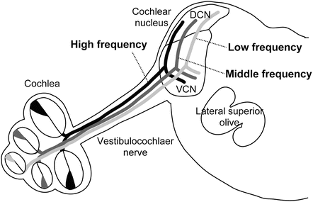 Cochlear Implant: Past, Present, and Future | SpringerLink