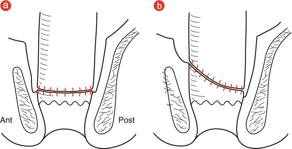 Hirschsprung’s Disease | SpringerLink