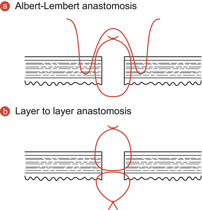 Gastrointestinal Anastomosis | SpringerLink