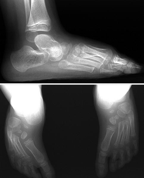 In-Toeing and Out-Toeing Gait | SpringerLink