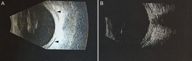 Posterior Scleritis | SpringerLink
