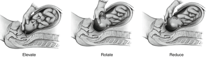 Difficulty in the Delivery of a Baby During LSCS | SpringerLink
