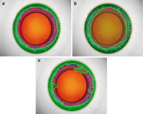 Descemet Membrane Endothelial Keratoplasty (DMEK) Surgery with a ...