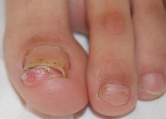 Tumors of the Nails | SpringerLink