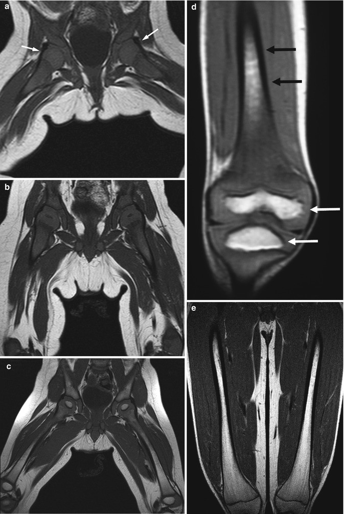 MRI of the Normal Bone Marrow: Anatomic Sites | SpringerLink