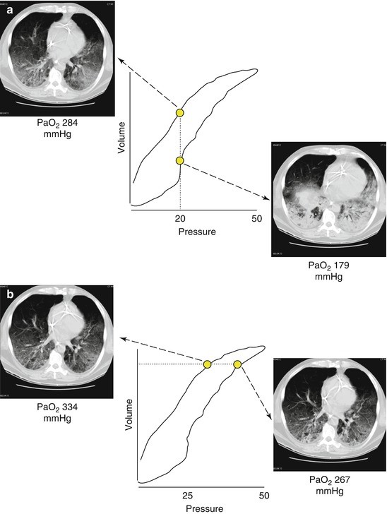 Lung Recruitment and De-recruitment | SpringerLink