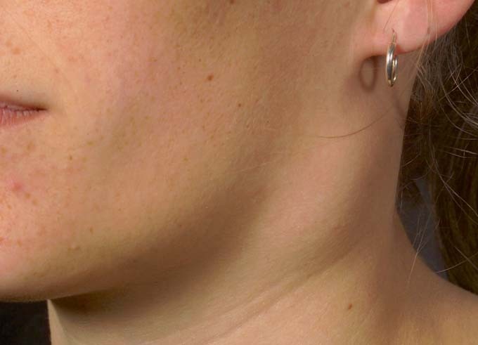 Afwijkingen van de hals | SpringerLink