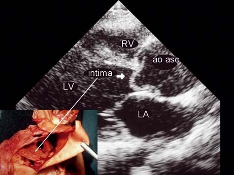 13 De aortaklep | SpringerLink
