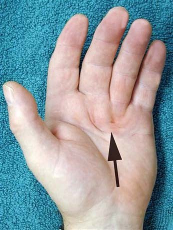 8 Een 48-jarige man met een ‘kromme’ ringvinger van zijn rechterhand ...