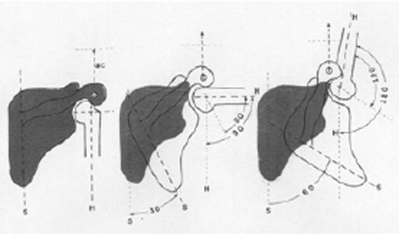Scapula alata: een tijdelijk maar frequent voorkomend restletsel na ...