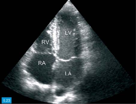 Linker en rechter atrium | SpringerLink
