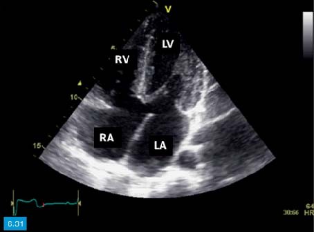 Linker en rechter atrium | SpringerLink