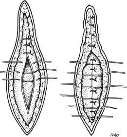 5 Wondgenezing en wondbehandeling | SpringerLink