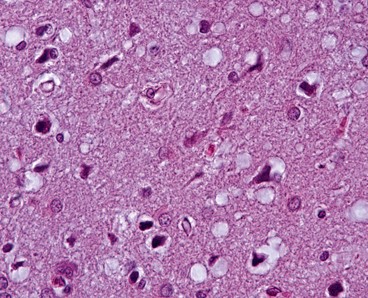 Human Prion Diseases: From Kuru to Variant Creutzfeldt-Jakob Disease ...
