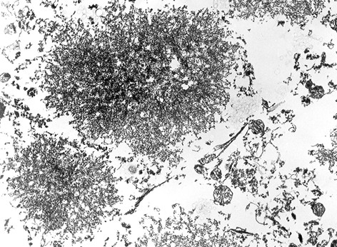 Human Prion Diseases: From Kuru to Variant Creutzfeldt-Jakob Disease ...