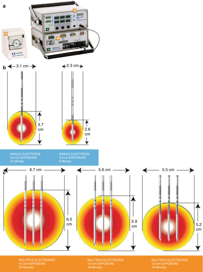 Radiofrequency Ablation Systems and Operating Mechanisms | SpringerLink