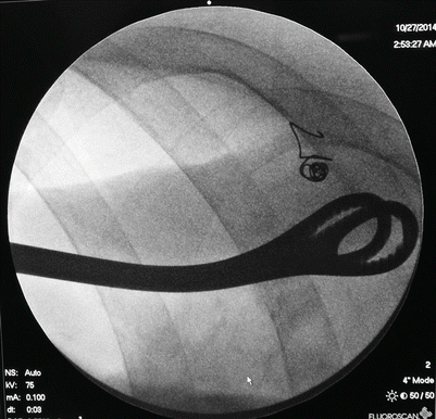 Wedge Resection | SpringerLink