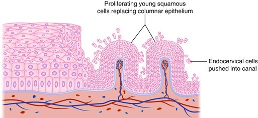 Colposcopic Appearance of Normal Cervix | SpringerLink