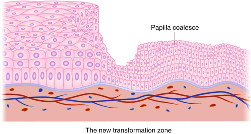 Colposcopic Appearance of Normal Cervix | SpringerLink