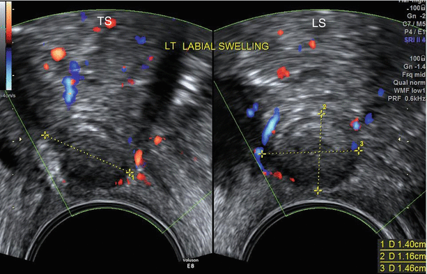 Ultrasound Evaluation of the Vagina | SpringerLink