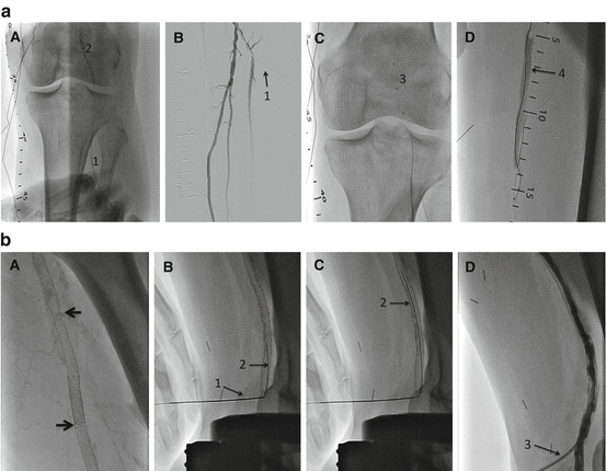 Femoropopliteal Artery Chronic Total Occlusion Intervention | SpringerLink
