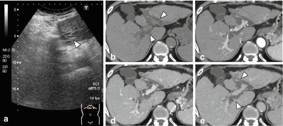 Pathology and Imaging of Peribiliary Cysts: Recent Progress | SpringerLink