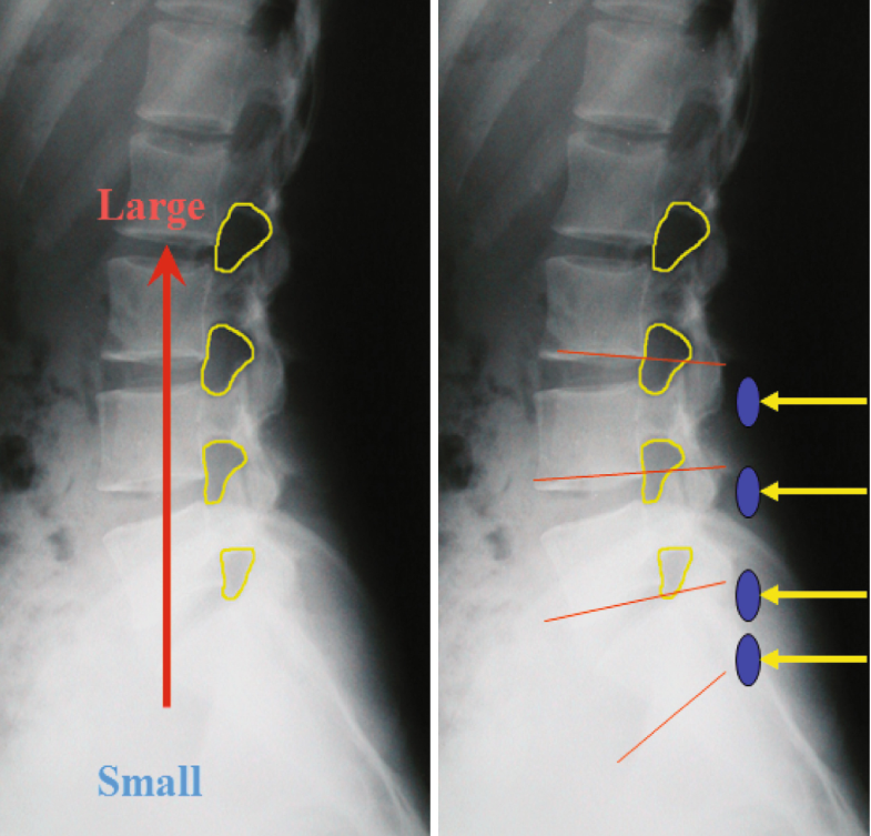 Percutaneous Full-Endoscopic Interlaminar Lumbar Spine Surgery ...