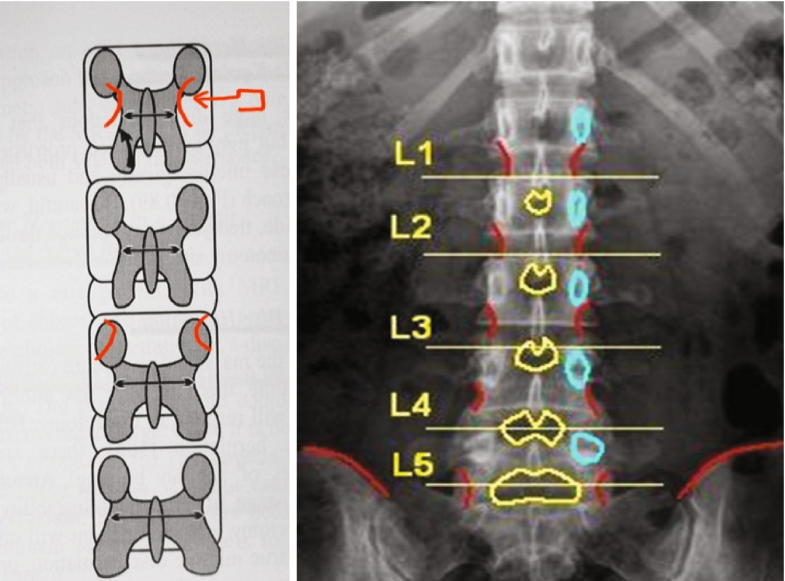 Percutaneous Full-Endoscopic Interlaminar Lumbar Spine Surgery ...