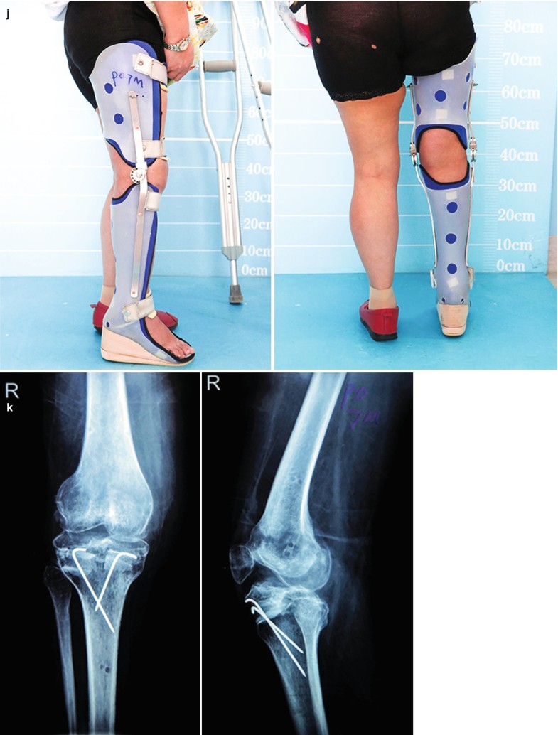 Application of the Ilizarov Technique | SpringerLink