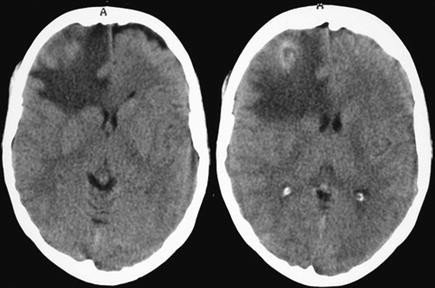 Tumours and Infections (☞ SOL) | SpringerLink