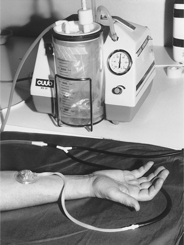 Suction Blister Model of Wound Healing | SpringerLink