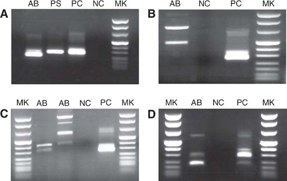 Diagnosis and Monitoring of PML-RARA-Positive Acute Promyelocytic ...