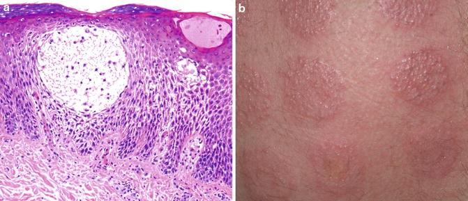 Spongiosis | SpringerLink
