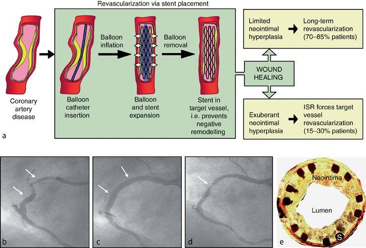 Stent Restenosis | SpringerLink