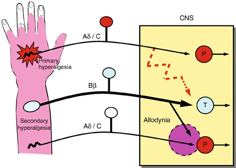 Hyperalgesia and Allodynia | SpringerLink