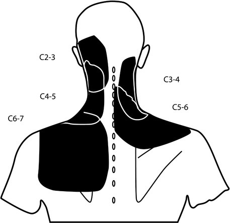 Somatic Referred Pain | SpringerLink