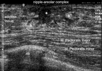 Gynecomastia | SpringerLink