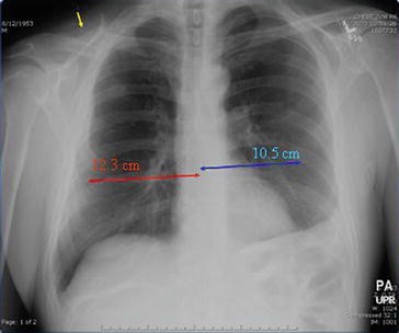 Scapulothoracic Dissociation | SpringerLink