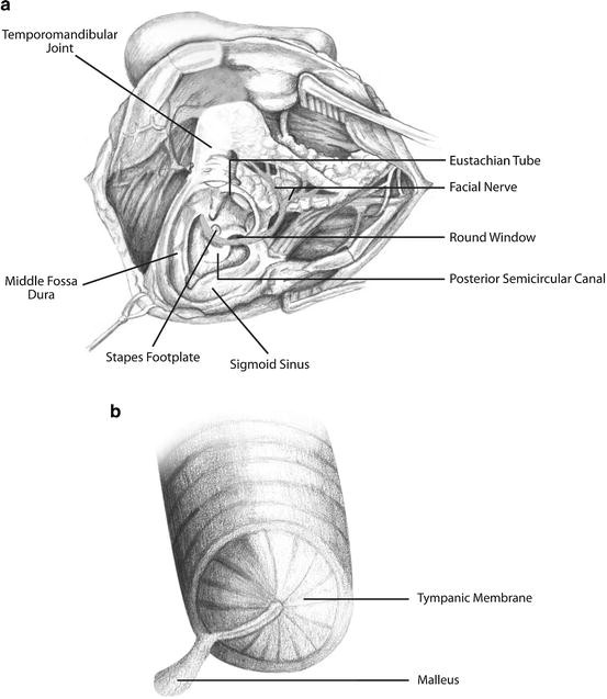 Lateral Temporal Bone Resection | SpringerLink