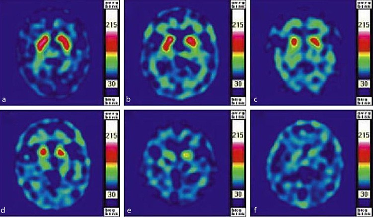 SPECT Imaging | SpringerLink