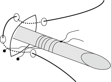 Removal Chest Drain Purse String Suture - Best Drain Photos Primagem.Org
