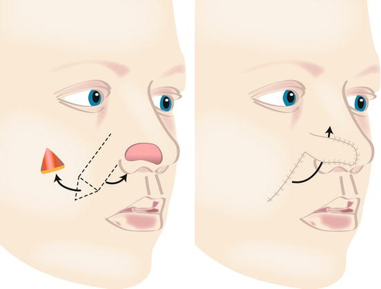 Interpolation Flaps | SpringerLink