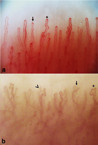 Recent advances in capillaroscopy | Clinical Rheumatology
