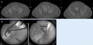 The Stoppa approach for acetabular fracture | SpringerLink