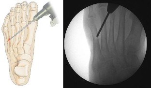 Minimally invasive bunionette correction | SpringerLink