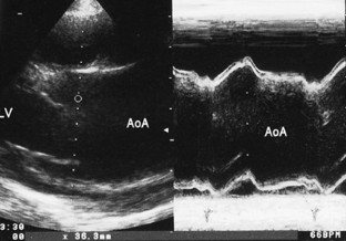 Ektasie und Knickbildungen der Aorta, Hypertelorismus und Uvula bifida ...